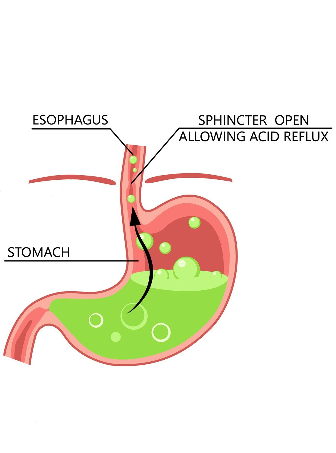 Acid Reflux Diagram