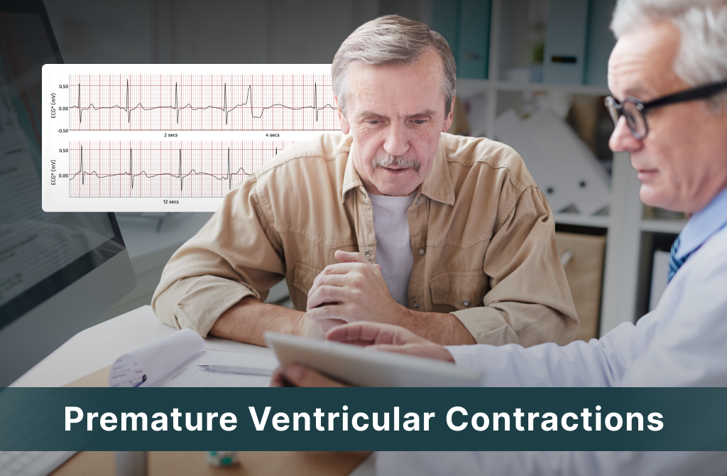 Premature Ventricular Contractions (PVCs) Explained